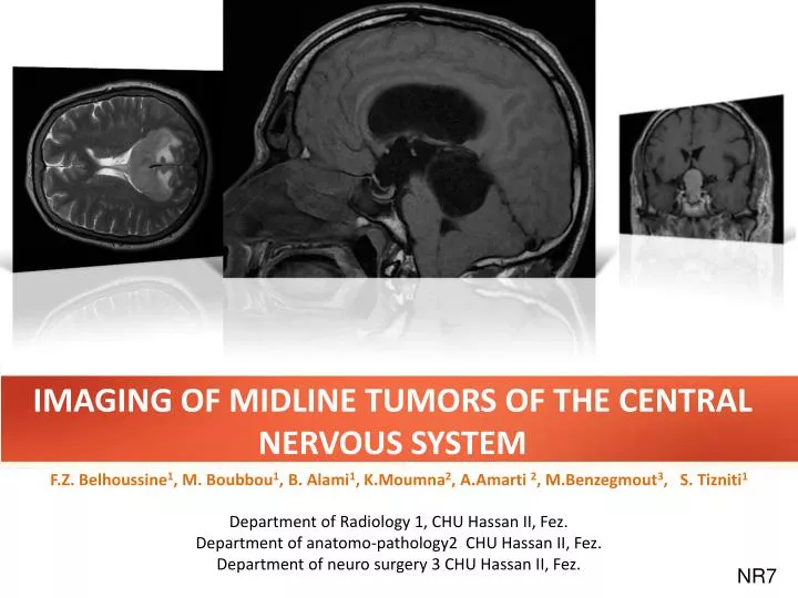 PPT - IMAGING OF MIDLINE TUMORS OF THE CENTRAL NERVOUS SYSTEM ...