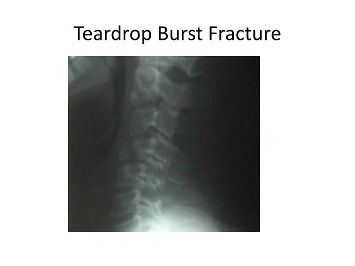 PPT - Cervical Spine Trauma PowerPoint Presentation - ID:2350127