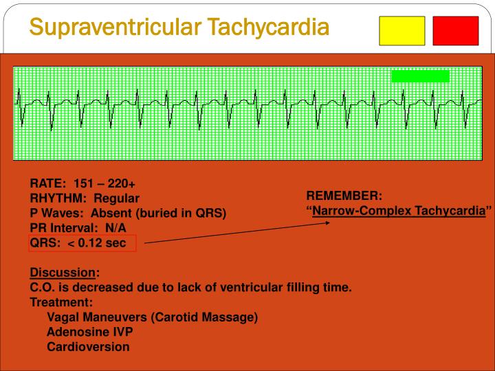 Supraventricular Tachycardia Treatment