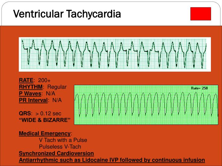 PPT - Cardiovascular--- EKG’s / Cardiac Monitoring PowerPoint ...