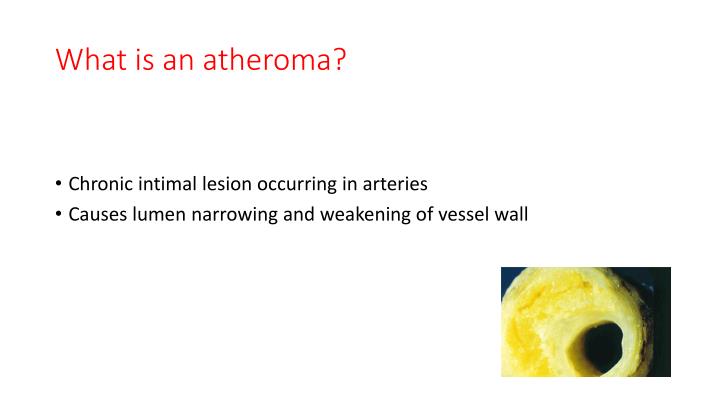 PPT - Atherosclerosis PowerPoint Presentation - ID:2352142