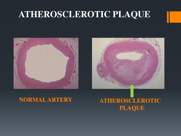 PPT - Introduction to: Atherosclerosis PowerPoint Presentation - ID:2352192