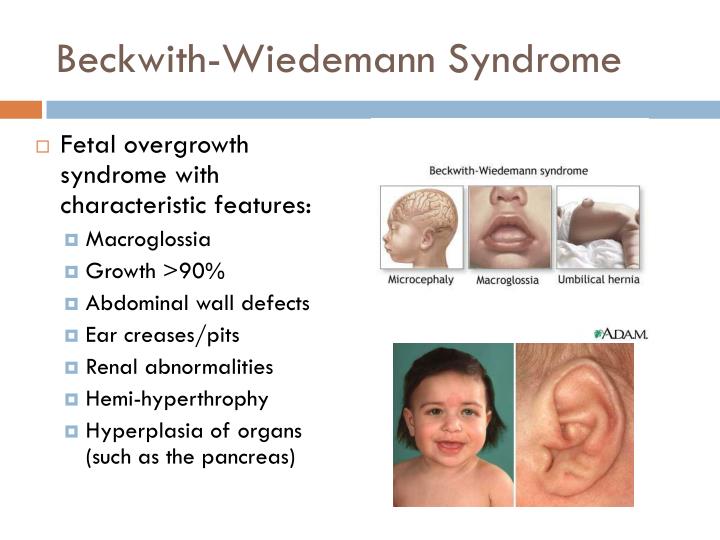 Beckwith Wiedemann Syndrome Adult