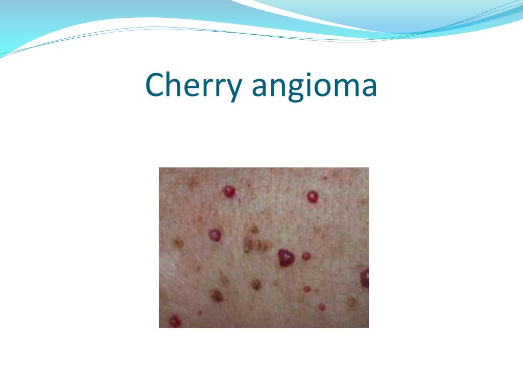 PPT - SKIN LESIONS , BENIGN AND MALIGNANT PowerPoint Presentation, free ...