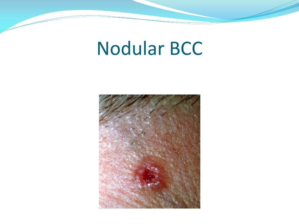 PPT - SKIN LESIONS , BENIGN AND MALIGNANT PowerPoint Presentation, free ...
