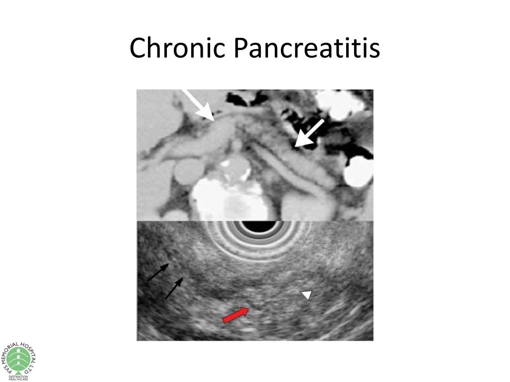 PPT - Recurrent Acute Pancreatitis with Normal LFT, USG & CECT ...
