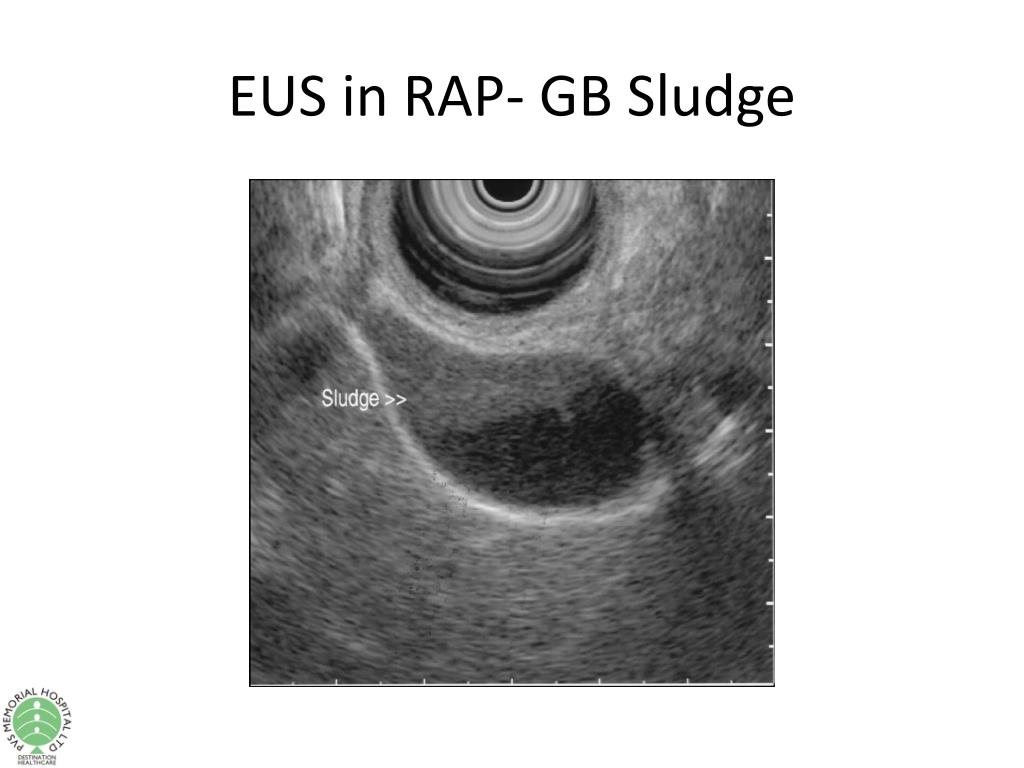 PPT - Recurrent Acute Pancreatitis with Normal LFT, USG & CECT ...