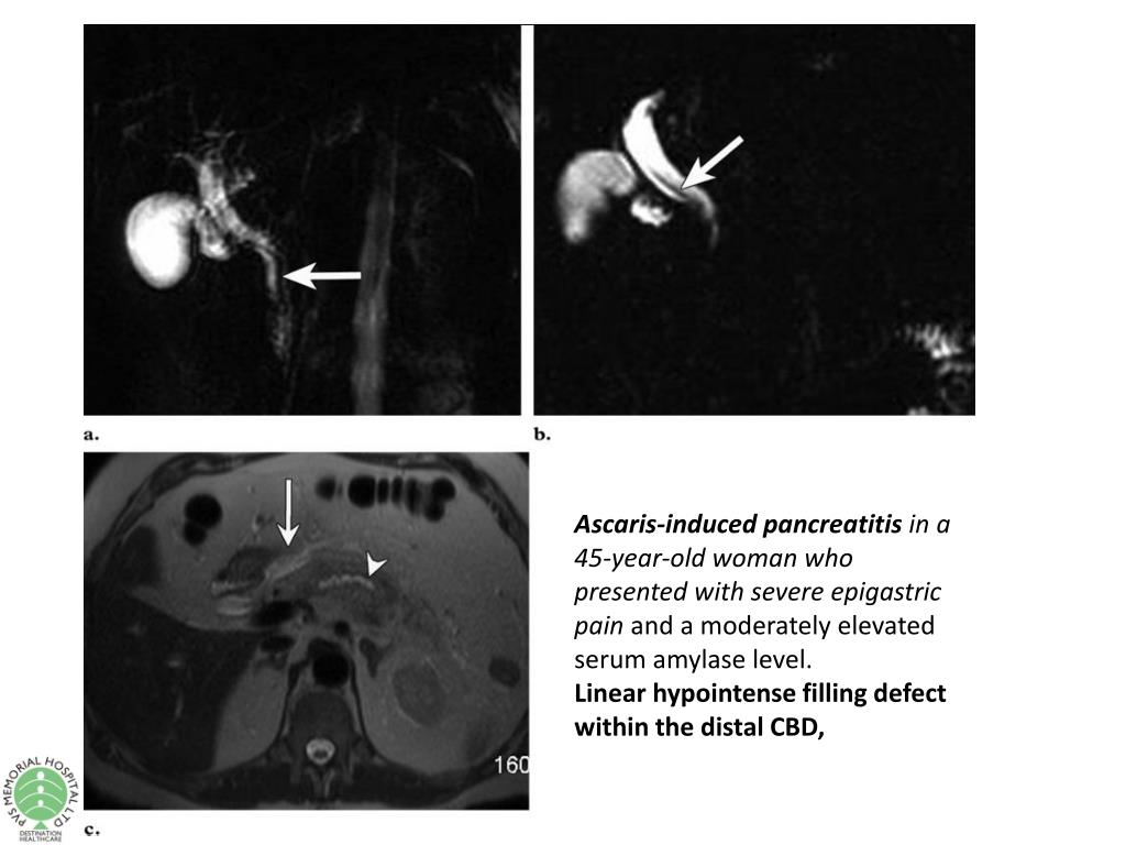 PPT - Recurrent Acute Pancreatitis with Normal LFT, USG & CECT ...