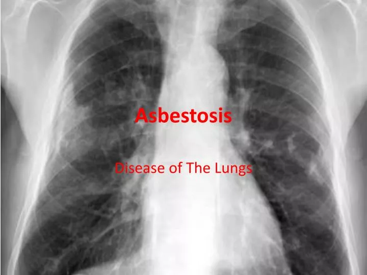 PPT - Asbestosis PowerPoint Presentation, free download - ID:2355628