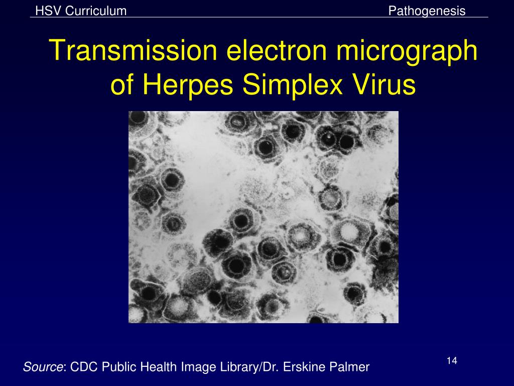 PPT - Genital and Perirectal Herpes Simplex Virus Infection PowerPoint ...
