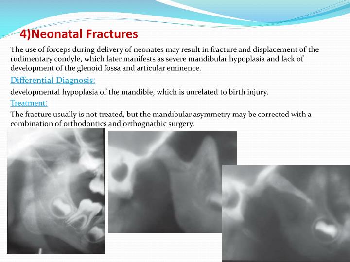 PPT - Diagnostic Imaging of the Temporomandibular Joint PowerPoint ...