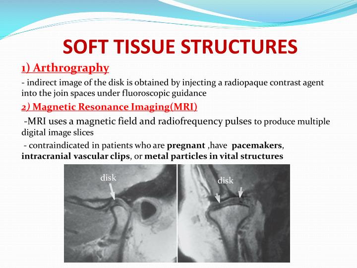 PPT - Diagnostic Imaging of the Temporomandibular Joint PowerPoint ...