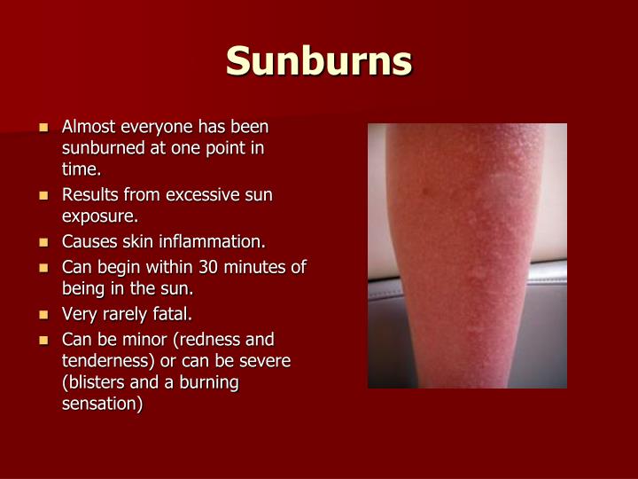 PPT - Burns PowerPoint Presentation - ID:2358828