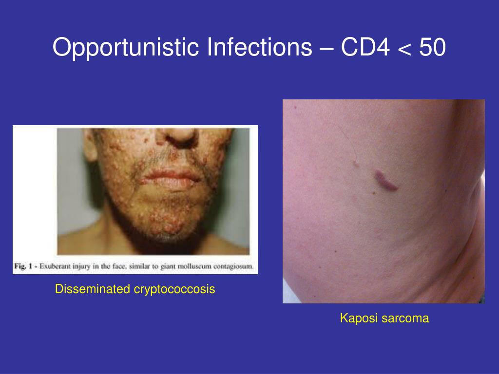 PPT - HIV / AIDS & Opportunistic Infections PowerPoint Presentation ...
