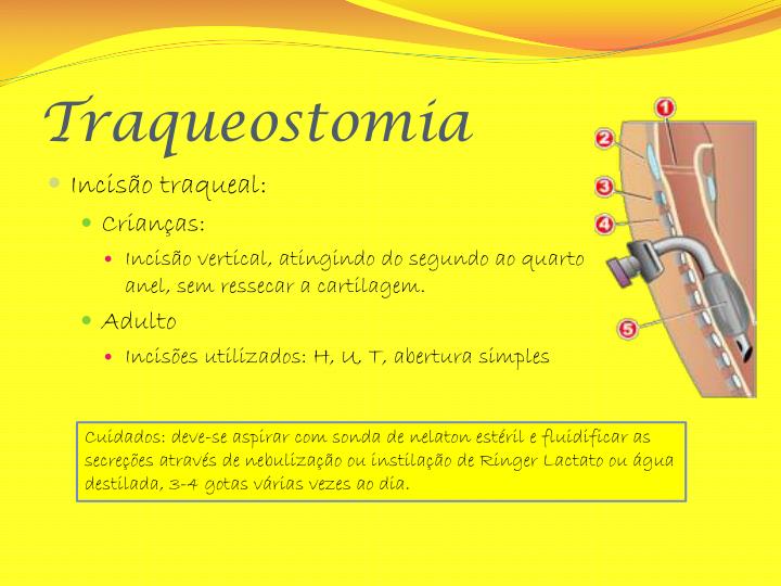 PPT - Via aérea cirúrgica PowerPoint Presentation - ID:2360869