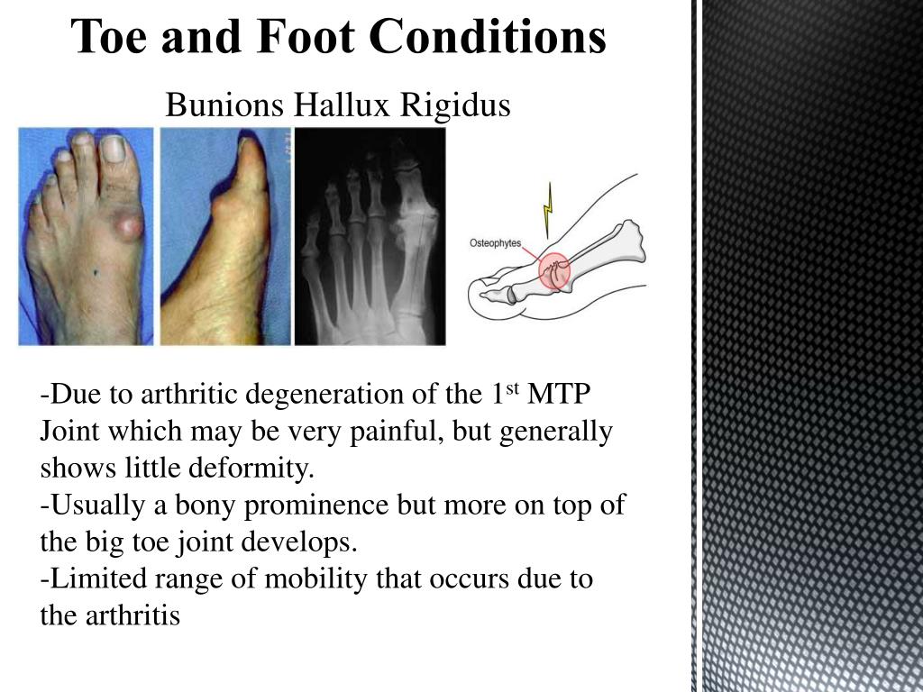 PPT - Anatomy of The Foot & Ankle PowerPoint Presentation, free ...
