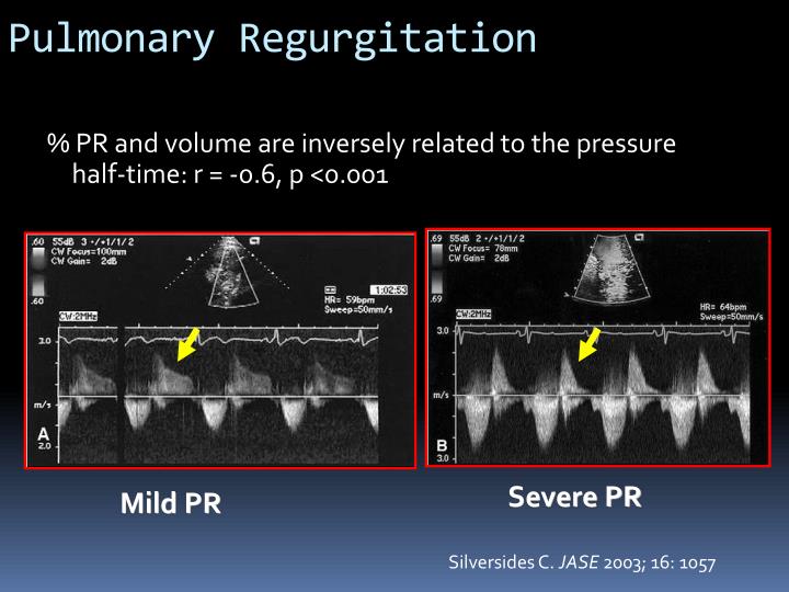 PPT - Tetralogy of fallot for the adult cardiologist PowerPoint ...