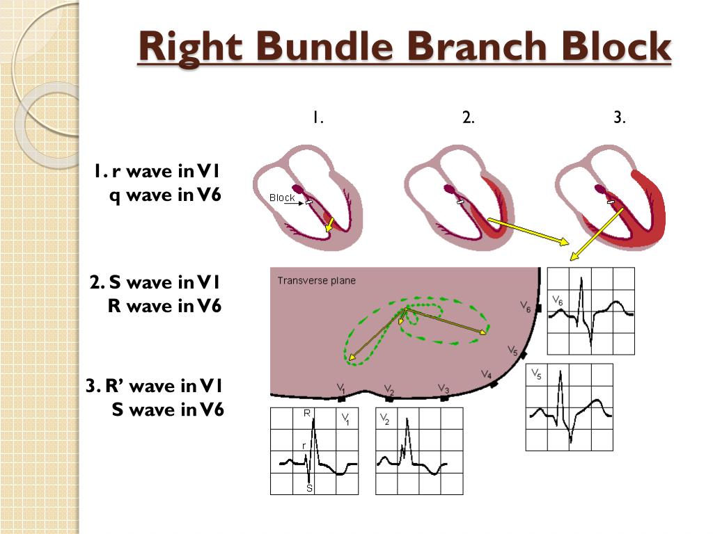 Right Bundle Branch Block Images - vrogue.co Right Bundle Branch Block Images - vrogue.co