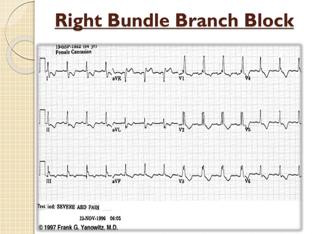 Medial Bundle Branch Block Medial Bundle Branch Block