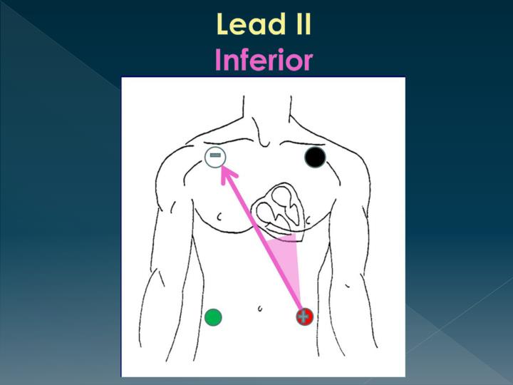 PPT - What Does your “I” See: Ischemia, Injury or Infarction ...