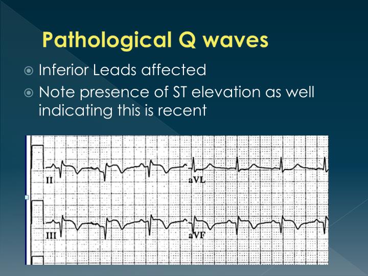 PPT - What Does your “I” See: Ischemia, Injury or Infarction ...