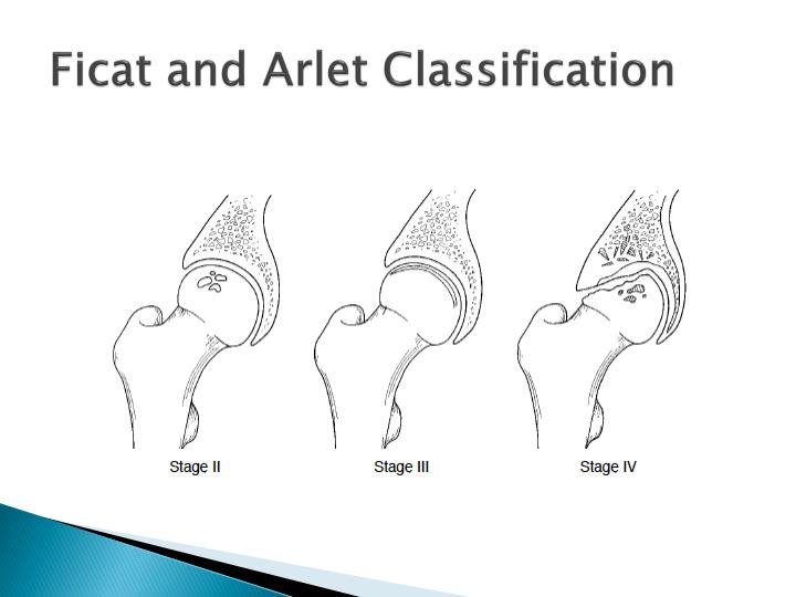 PPT - Osteonecrosis of the Hip: Diagnosis and Management of Ficat I and ...