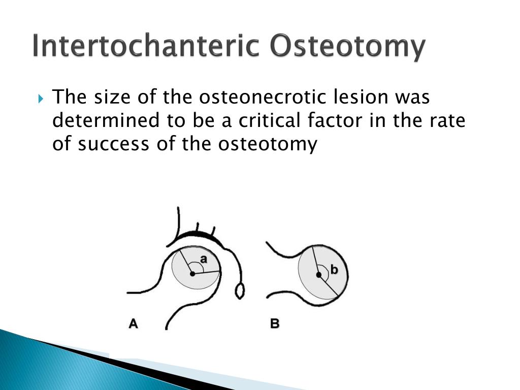 PPT - Osteonecrosis of the Hip: Diagnosis and Management of Ficat I and ...