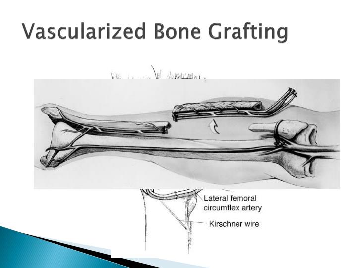 PPT - Osteonecrosis of the Hip: Diagnosis and Management of Ficat I and ...