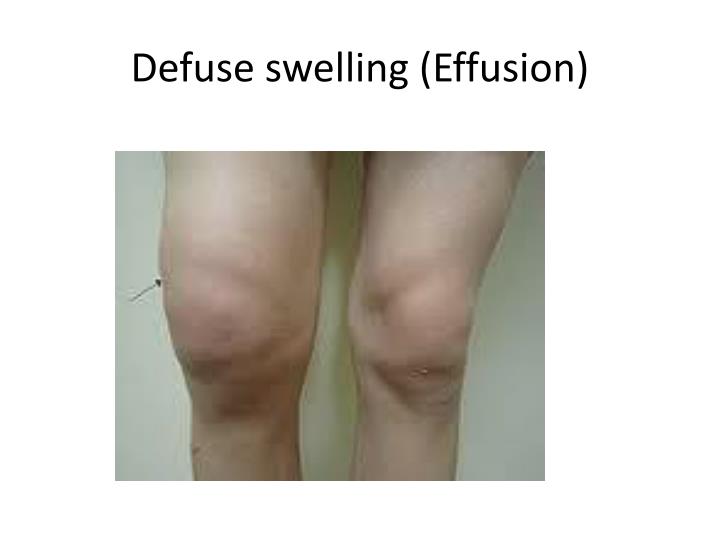 PPT - Knee Examination PowerPoint Presentation - ID:2365304