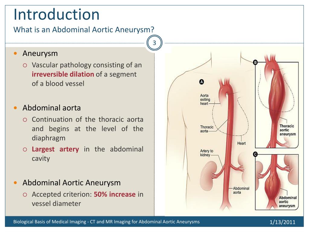 Ppt Ct And Mr Imaging Of Abdominal Aortic Aneurysm Powerpoint Images And Photos Finder