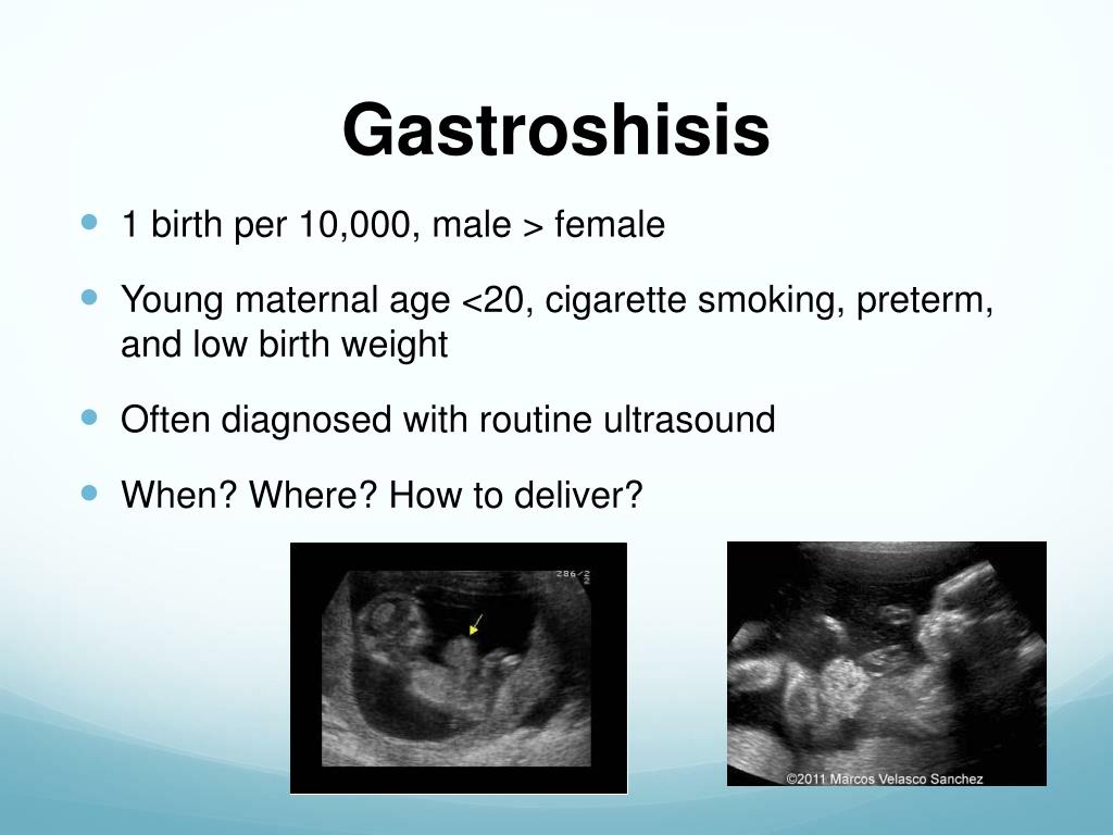 PPT - Anesthetics Management for Neonates with Gastroschisis Repair ...