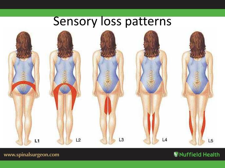PPT - Sciatica Differential Diagnosis PowerPoint Presentation - ID:2368999
