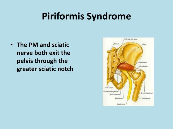 PPT - Piriformis Syndrome PowerPoint Presentation - ID:2369133