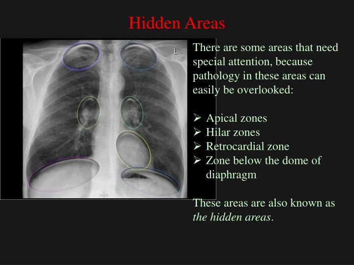 PPT - Chest X-Ray Basic Interpretation PowerPoint Presentation - ID:2369751