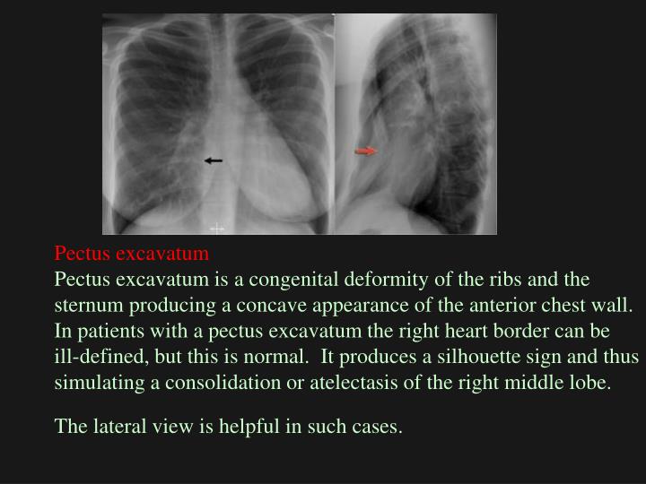 PPT - Chest X-Ray Basic Interpretation PowerPoint Presentation - ID:2369751