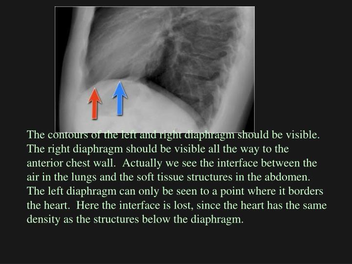 PPT - Chest X-Ray Basic Interpretation PowerPoint Presentation - ID:2369751