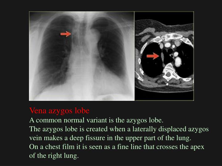 PPT - Chest X-Ray Basic Interpretation PowerPoint Presentation - ID:2369751