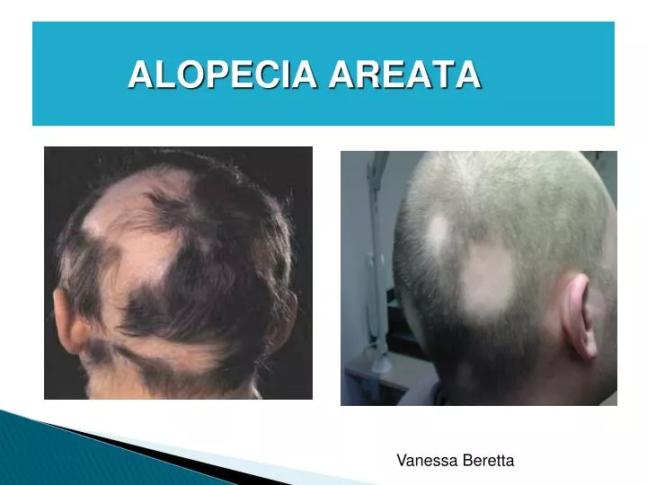PPT - ALOPECIA AREATA PowerPoint Presentation, free download - ID:2370966