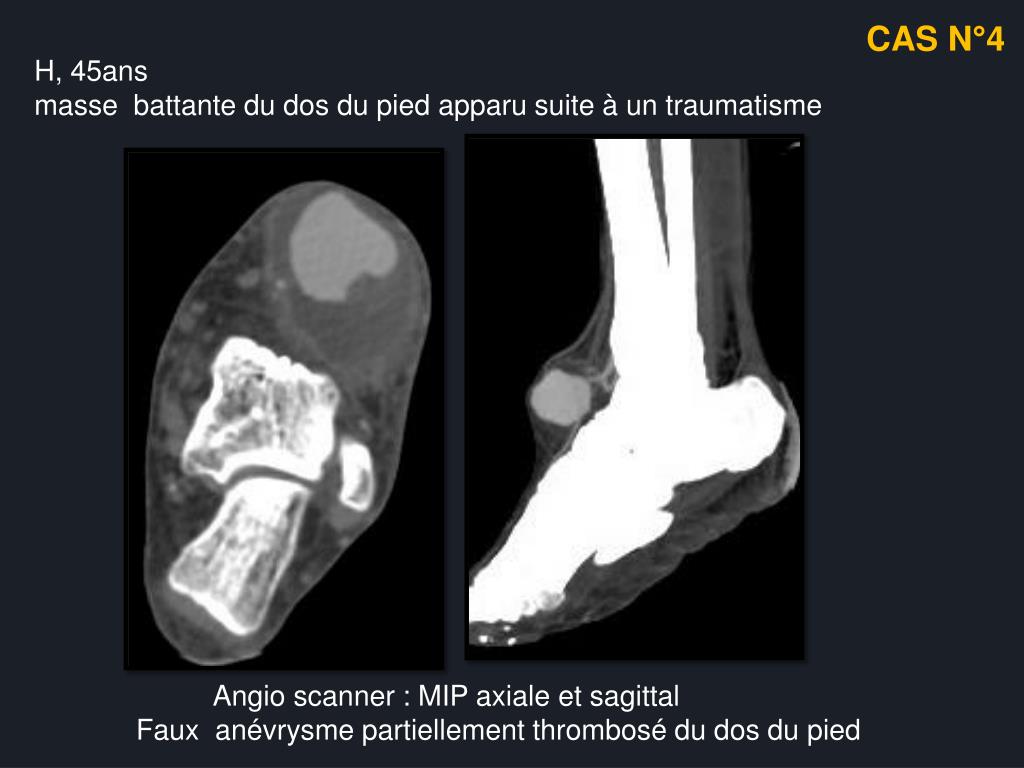 PPT - Angio -scanner des membres inférieurs: indications, aspects ...