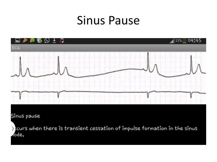 PPT - Neonatal Arrhythmia PowerPoint Presentation - ID:2372147