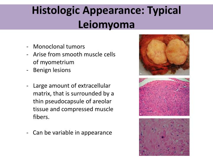 PPT - Uterine Leiomyoma PowerPoint Presentation - ID:2372404