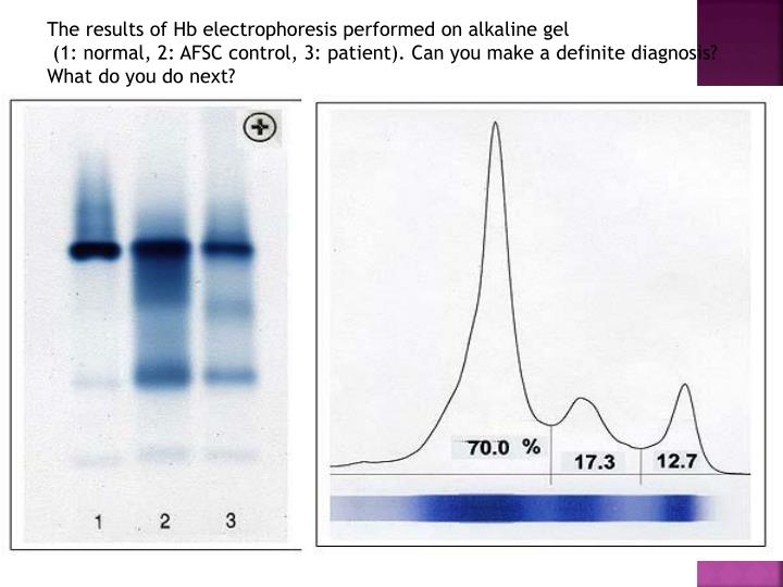 PPT - Hemoglobin Electrophoresis PowerPoint Presentation - ID:2372418