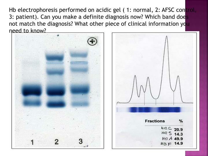 PPT - Hemoglobin Electrophoresis PowerPoint Presentation - ID:2372418