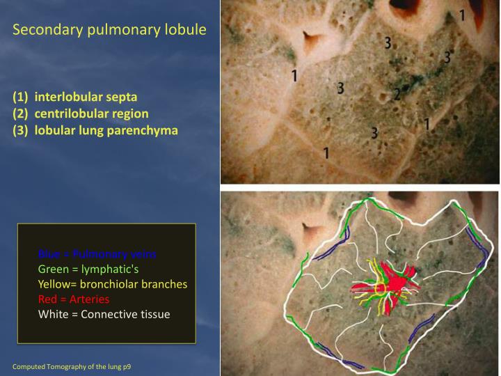 PPT - Lung Nodules PowerPoint Presentation - ID:2372940