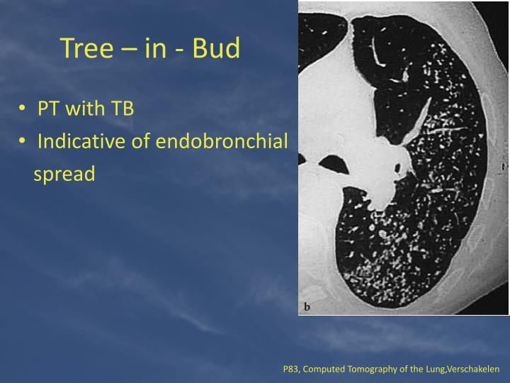 PPT - Lung Nodules PowerPoint Presentation - ID:2372940