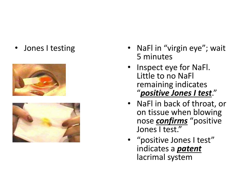 PPT - What is needed for diagnosis of dry eye (hint: needed to avoid ...