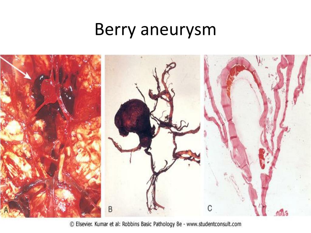 Ppt 2 Subarachnoid Hemorrhage Powerpoint Presentation Free Download