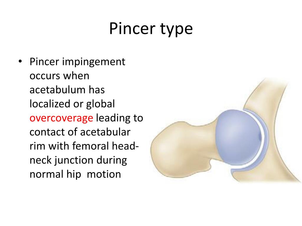 PPT - HIP PAIN IN THE YOUNG ADULT PowerPoint Presentation, free ...