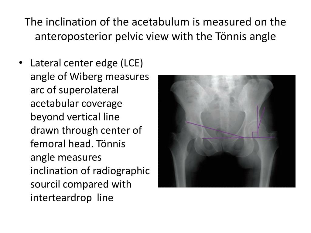 PPT - HIP PAIN IN THE YOUNG ADULT PowerPoint Presentation, free ...
