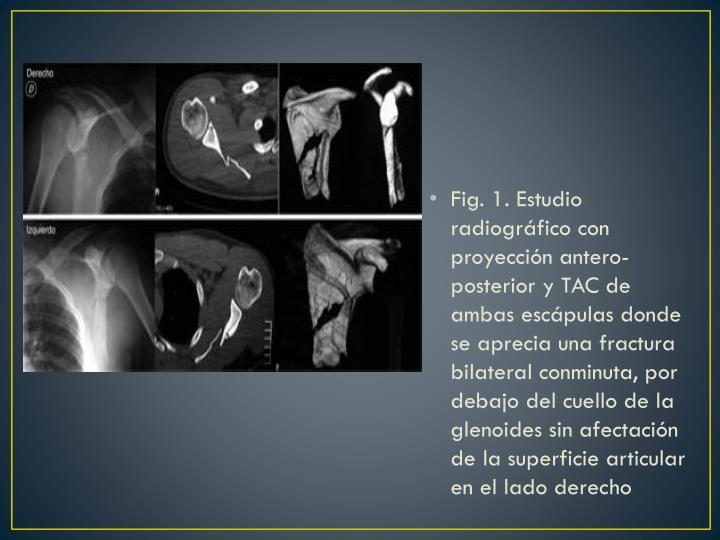 PPT - FRACTURA DE ESCÁPULA PowerPoint Presentation - ID:2381696